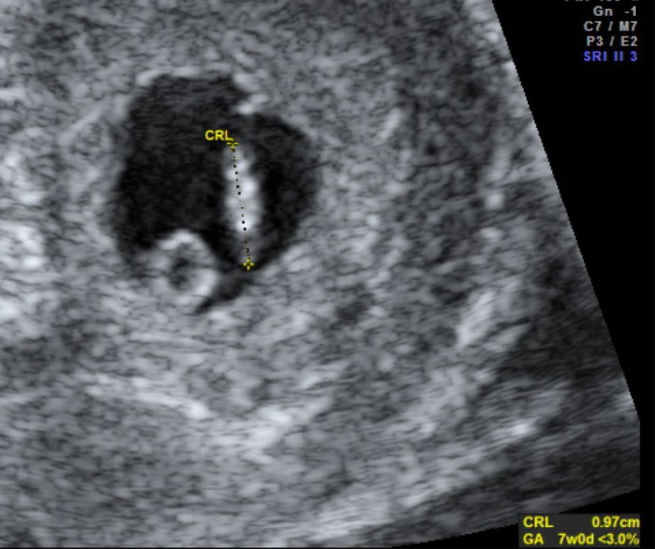 Ultrasound Best - Our Services - Early Scans