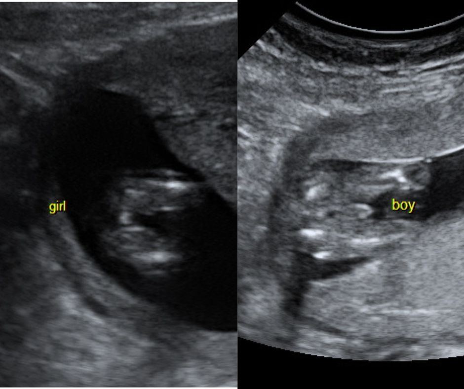 Ultrasound Best - Our Services - Gender Scans
